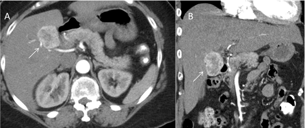 FULL TEXT - A mass in the porta hepatis: A rare presentation of ectopic ...